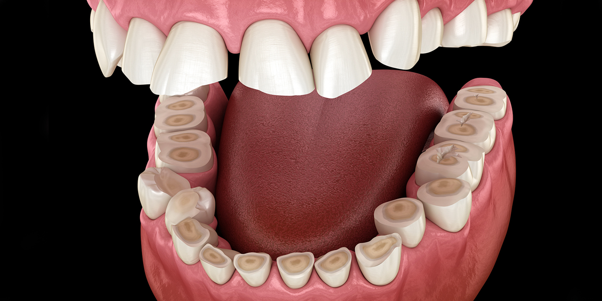 Teeth Grinding Bruxism Eastern Dental Teeth Grinding Bruxism Eastern Dental